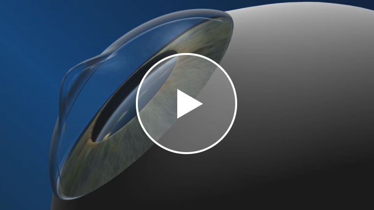 Lifetime Eyecare || Keratoconus Animation