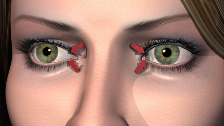 Advanced Eyecare Specialists || Punctual Plugs