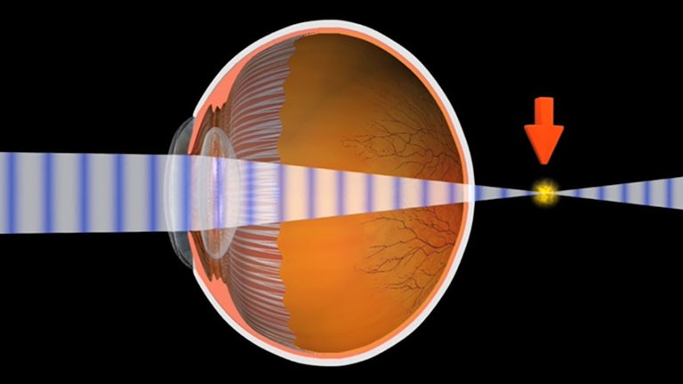 Harbor View Eye Care || Hyperopia Myopia