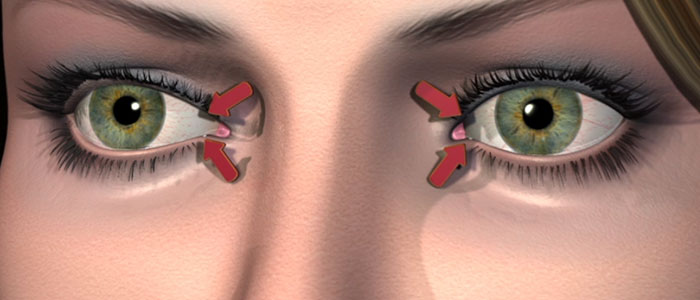 Lifetime Eyecare || Punctual Plugs